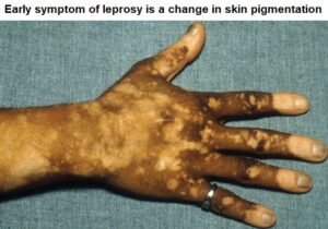 Hansen’s Disease: Symptoms, Causative Agent, Pathogenesis and Treatment