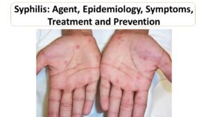 Tertiary Syphilis - Microbiology Notes