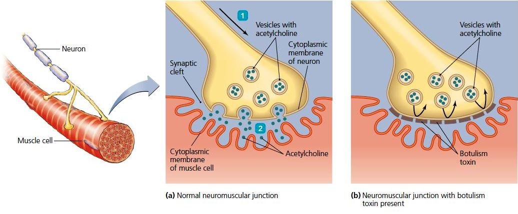 Botulism- Etiology, Pathogenesis, Treatment and Prevention