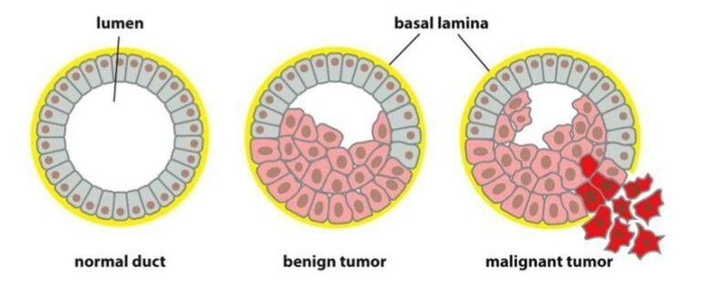 Cancer: Intro, Types, Development and Therapy